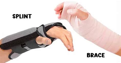 Difference Between Brace And Splint At Ella Kendall Blog