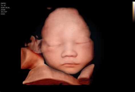 Ultrasound Image Gallery Thesuite Learn Without Limits