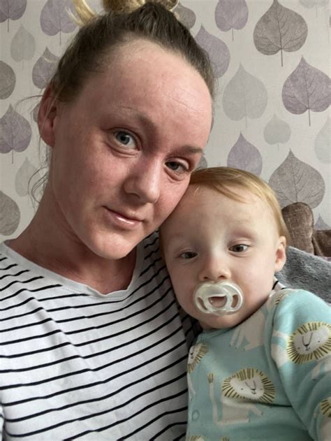 Excruciating Rashes From Steroid Cream Withdrawal Left Mum Suicidal