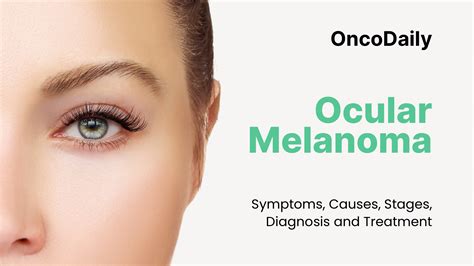 Ocular Melanoma Symptoms Causes Stages Diagnosis And Treatment