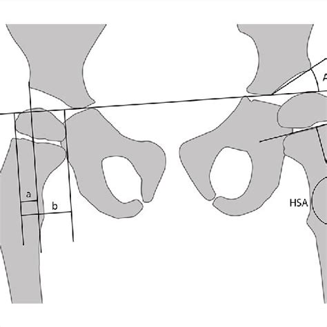 Schematic Drawing Showing The Radiographic Measurements Migration Download Scientific Diagram