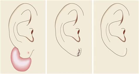Ear Keloid Removal A D S Clinic The Best Techniques The Best