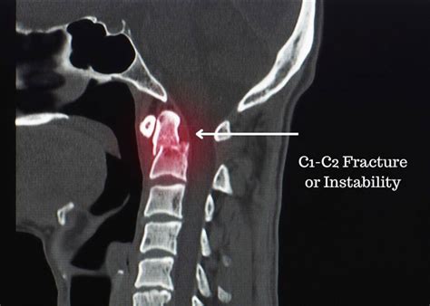 Atlantoaxial Instability C1 C2 Neck Fracture Specialist Clear Lake
