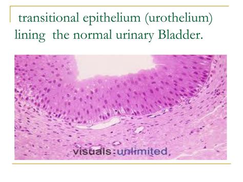 Ppt Bladder Carcinoma Powerpoint Presentation Free Download Id6685750