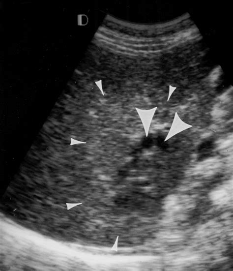 Echinococcus Multilocularis Revisited Ajr