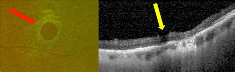 What The Hole When To Refer Retinal Holes Or Tears Mivision