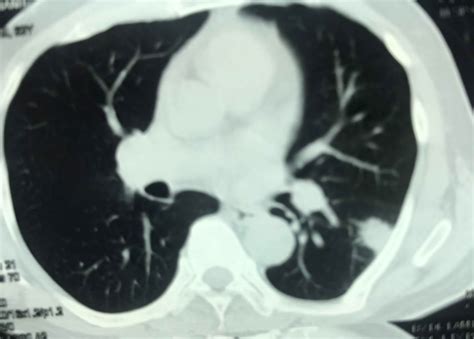 Vietnamese Medic Ultrasound Case 556 Lung Tumor Dr Phan Thanh Hai
