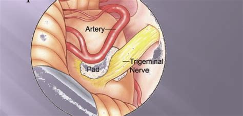 Trigeminal Neuralgia Legacy Spine Neurological Specialists