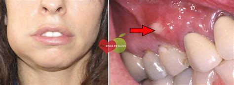 Abscesso Dentário O Que é Causas Sintomas E Tratamentos Dicas De