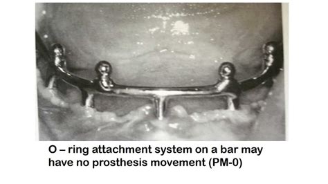 Implant Overdenture Misch Complete Notes Extooth