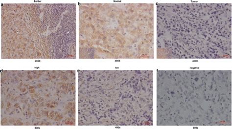 In Situ Hybridization Tested Mir 372 Expression In 120 Hcc Tissue Slice Download Scientific