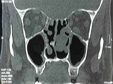 Macroscopic Appearance Of Removed Polypoid Lesion Consisted Of A 2 Cm Download Scientific