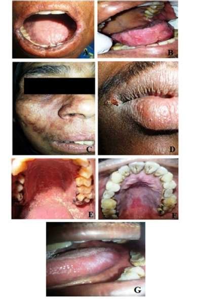 Angular Cheilitis Hiv