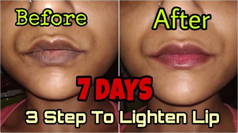 How Can I Lighten My Dark Lips Permanently