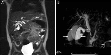 Gallbladder Duplication Pacs