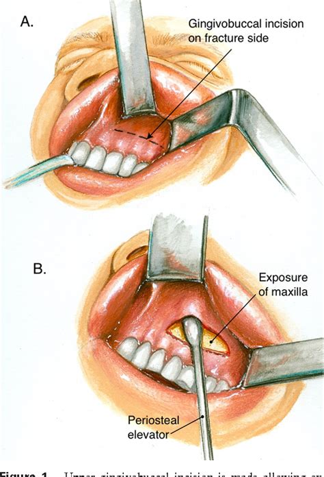 Figure 3 From Endoscopic Transantral Repair Of Orbital Floor Fractures
