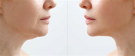 Fat Dissolving Injections — Winchester The Secret Garden Skin Clinic