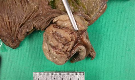 Diffuse Large B Cell Lymphoma In Appendix Springerlink