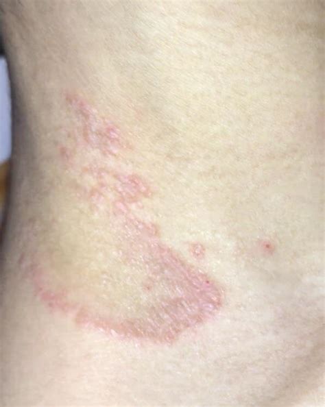 Please Help Me Identify What This Rash On My Neck Is Caused By It Has Been Around For About Two