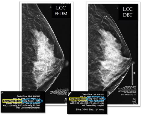 figure 1 from comparison of compression force and compressed breast