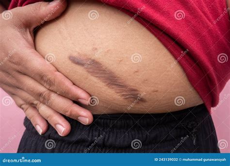 Keloid Scars On Stomach After Appendectomy Stock Photo Image Of Good
