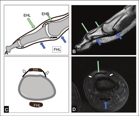 Extensor And Flexor Compartment Muscles Of The Great Toe A Sagittal