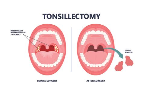 Tonsillectomy Jnu Hospital