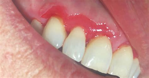 Pemphigus Vulgaris Oral Lesions