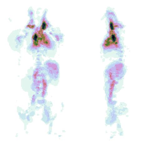 Newly Developed Image Registration Method For Whole Body PET CT Images Is Applied And Evaluated