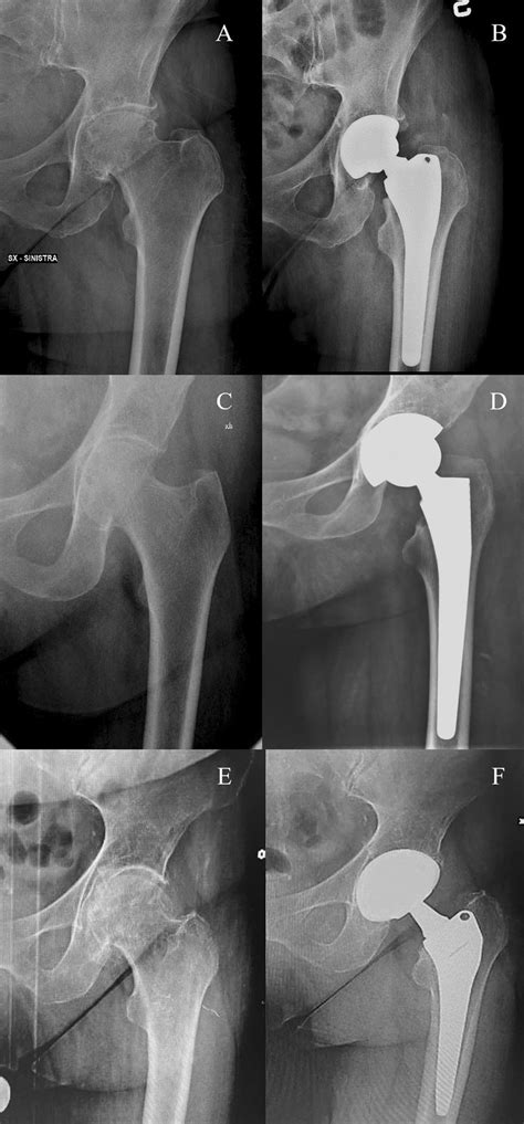 Preoperative A C E And Postoperative B D F Pelvis X Rays Of