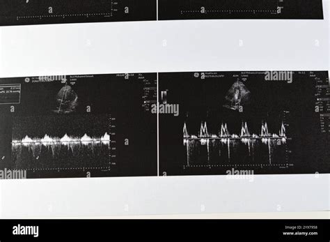Cairo Egypt November 15 2024 Cardiac Ultrasound Echocardiography A