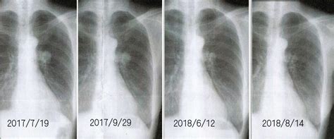 癌はどうやって消えていくか？ わかばクリニック｜希望の「がん治療」余命宣告からの