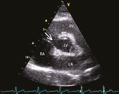 Aortic Stenosis Echocardiogram In Parasternal Short A