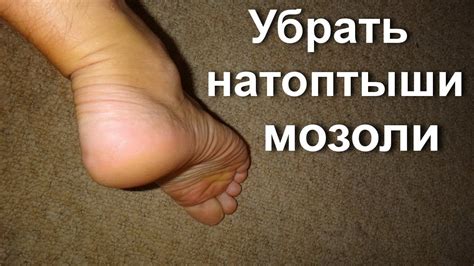 Как избавиться от натоптышей в домашних условиях - № 1 Народное лечение ...