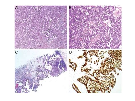 Papillary Lesions Of The Breastpptx