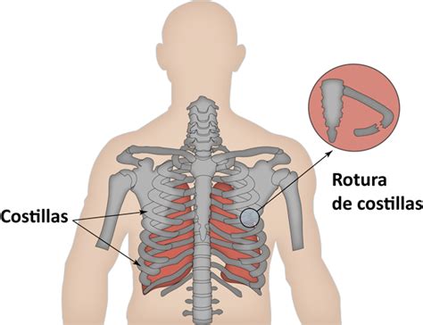 Instructor Dividir Vacante Fractura De Parrilla Costal Aspecto