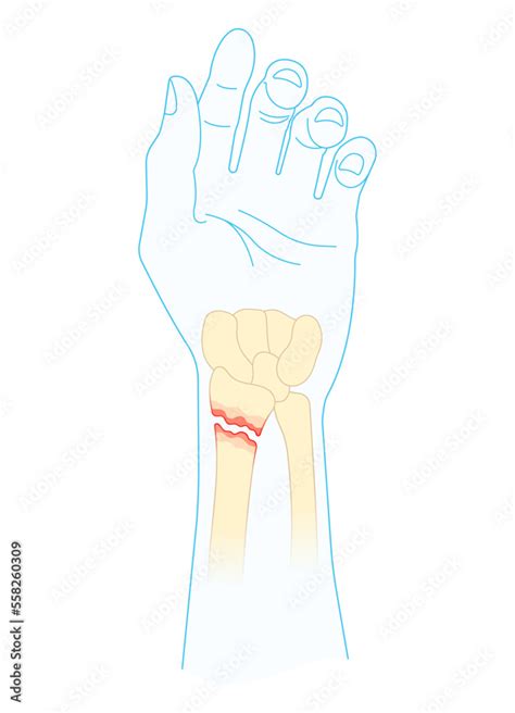 Hand Break Painful Radial Dislocated Fall Onto An Outstretched Closed