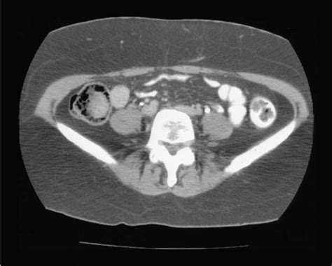 Female Pelvic Ct 1 Diagram Quizlet