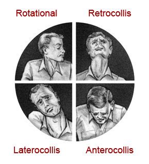 Spasmodic Torticollis Signs And Symptoms National Spasmodic