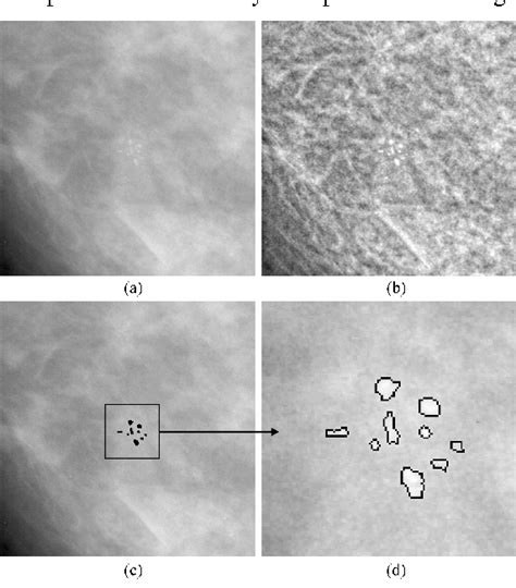 Figure 3 From Breast Cancer Diagnosis Analyzing Texture Of Tissue Surrounding