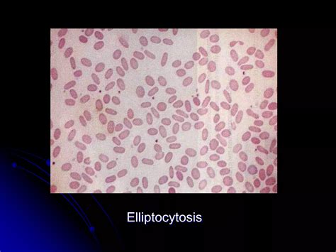 Hemolytic Anemia Classification By Thejus K Thilak Pptx