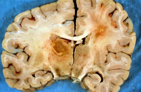 Toxoplasmosis Brain