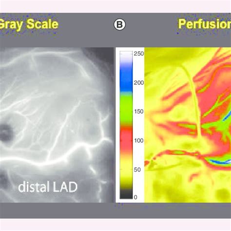 Opportunity In Near Infrared Fluorescence Imaging To Highlight Flow And Download Scientific