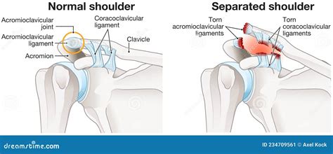 Acromioclavicular Joint Separation Or Ac Joint Separation Or Shoulder Separation Illustration