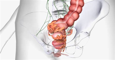 During Stage Iii Endometrial Cancer The Tumor Spreads Outside Of The