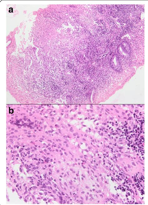 Biopsy From The Sigmoid Colon A Colonic Biopsy Showing Histiocytoid