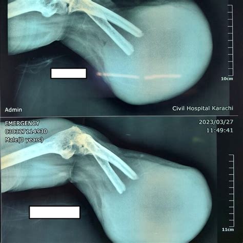 Recurrence After Below‐elbow Amputation Was Removed Download Scientific Diagram