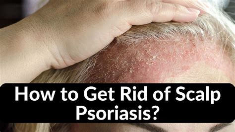 How To Get Rid Of Scalp Psoriasis Treatments That Work By Dr