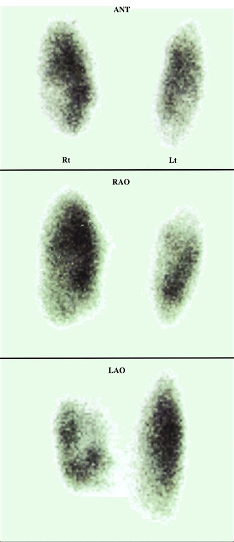 Tc‑99m Scan Of The Patient To Illustrate The High Uptake Download Scientific Diagram