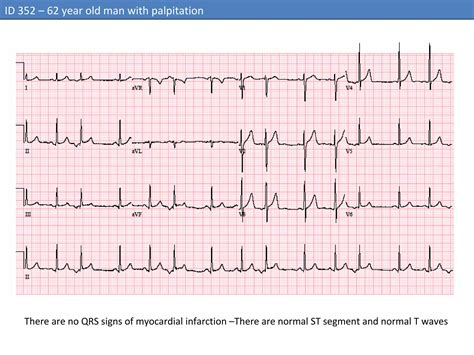 Id 352 Sinus Rhythm With Premature Atrial Complex Ppt
